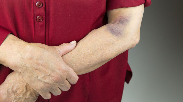 How to quickly heal a bruise - Starts at 60