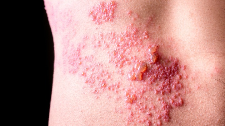 What’s this painful red rash? - Starts at 60