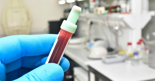 Blood test research gives hope for early detection of a common cancer ...