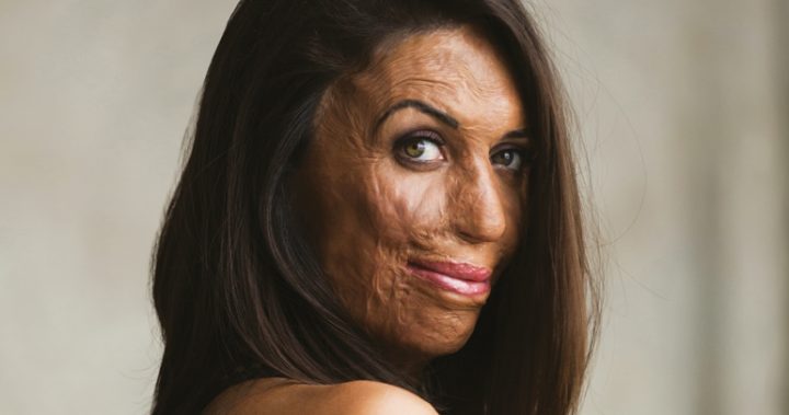 Turia Pitt’s remarkable story of survival and new life - Starts at 60