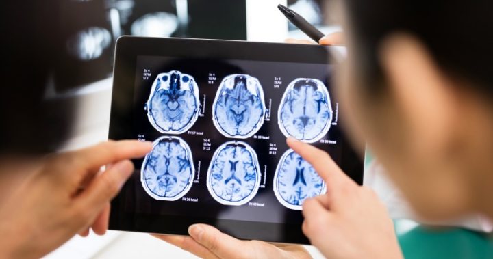 Dementia cure one step closer as trials to reverse symptoms get green ...